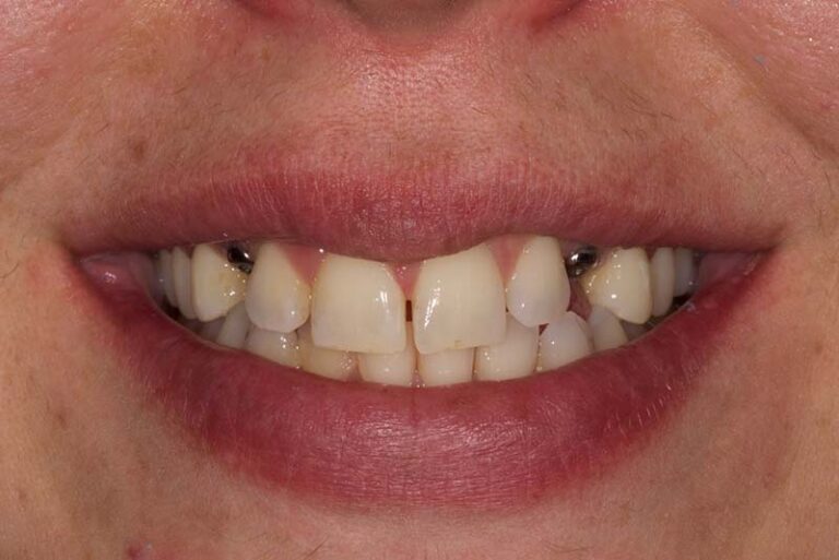 Smile Gallery - Wellspring Dental